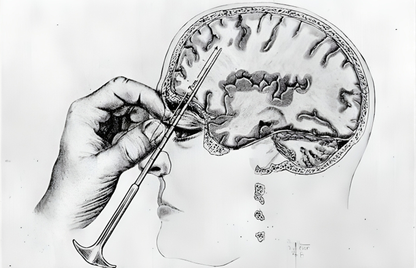 Lobotomi Nedir? Tarihçesi ve Vakaları