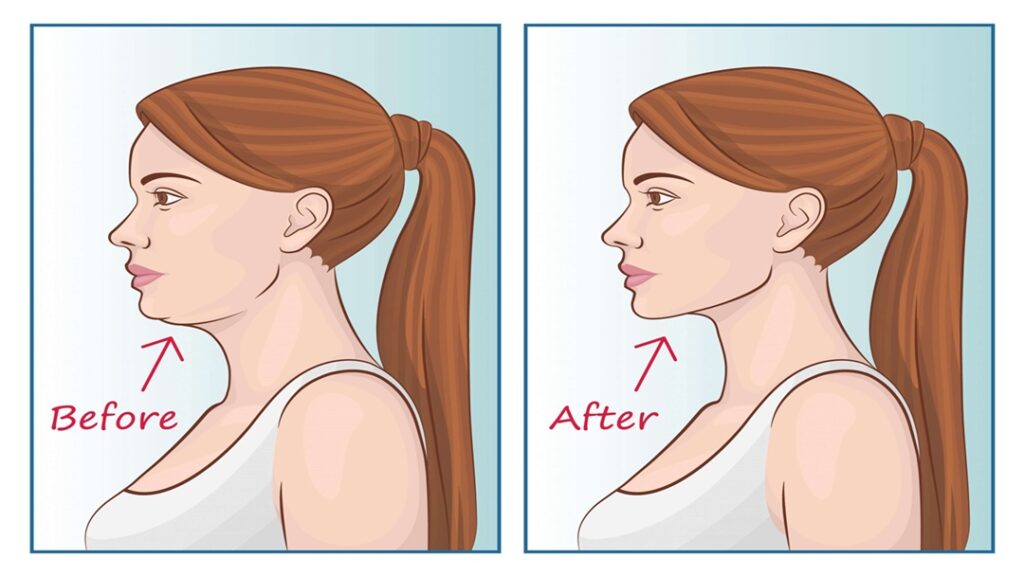 Mewing Nedir? Mewing Hareketi Nasıl Yapılır?